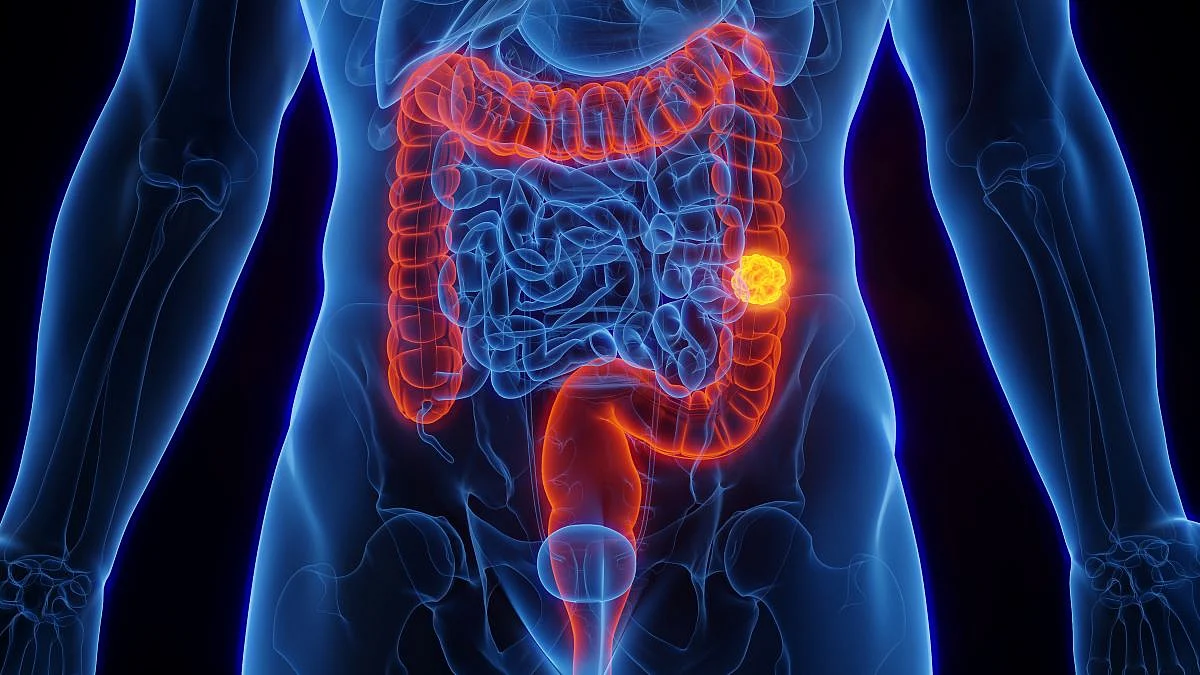 GI Cancers On The Rise Among Younger Adults - AEPC Health